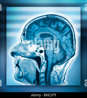 Normal human brain, Coloured magnetic resonance imaging (MRI) scan of a human head Stock Photo ...