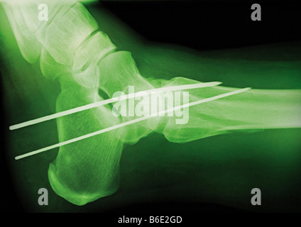 Pinned broken leg. Coloured X-ray of a pinned fracture of both the ...
