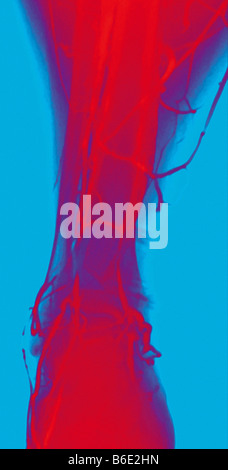 Leg Blood Vessels, Anatomical Illustration Stock Photo - Alamy