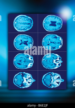 Normal brain, coloured axial (cross-sectional) computed tomography (CT ...