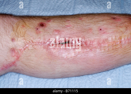 healing wound on the leg of a US soldier in Iraq caused by shrapnel ...