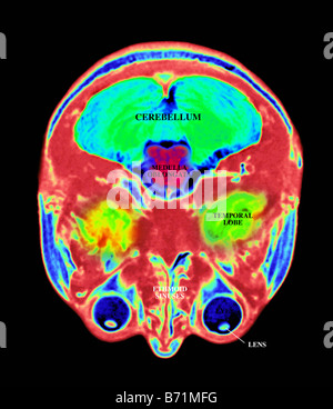 MRI scan of the brain, with the major structures labeled Stock Photo ...