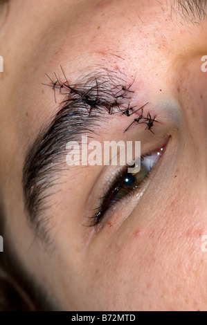 eyebrow laceration on a teenage boy Stock Photo - Alamy