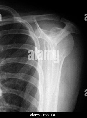 normal shoulder x-ray Stock Photo: 65494964 - Alamy