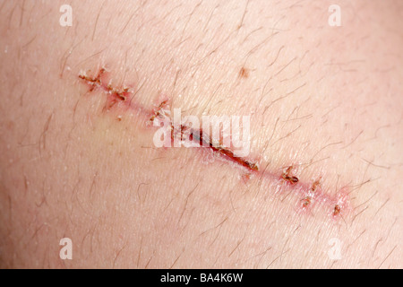 Epidermal cyst Stock Photo: 5482854 - Alamy