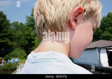 MODEL RELEASED. Young boy scratching his head with chickenpox spots on ...