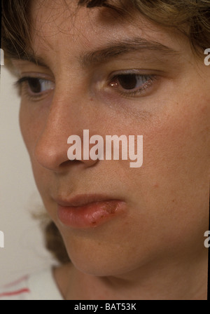 Cold sores on a woman's mouth. Cold sores are caused by the Herpes ...