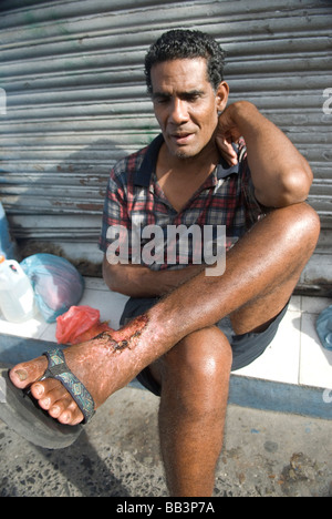 This man in Panama City was stung by a stingray 7 years ago Due to the ...