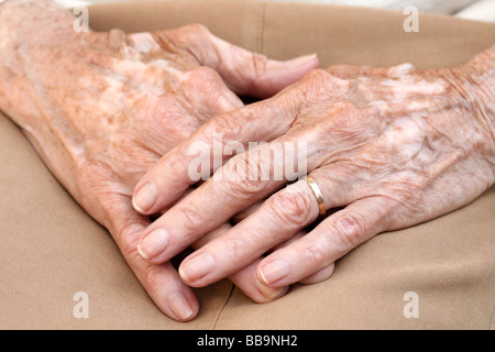hands of old woman with skin problems Stock Photo - Alamy