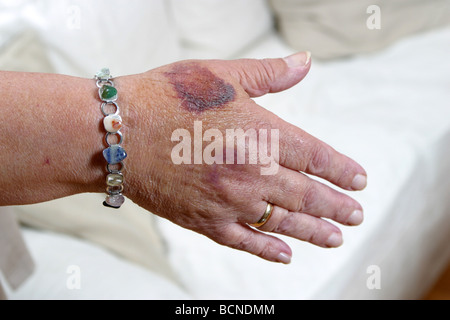 Bruise on skin of hand of an elderly woman, close-up photo Stock Photo ...