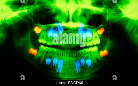 CHILD TOOTH, X-RAY Stock Photo - Alamy