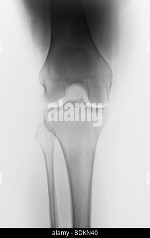 Normal Knee, X-ray Stock Photo - Alamy