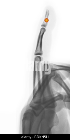 Foreign body in finger, X-ray Stock Photo - Alamy