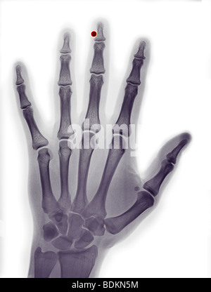 Foreign body in finger, X-ray Stock Photo - Alamy