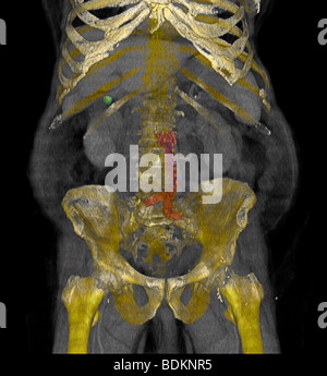 Color enhanced three-dimensional CT scan image of an 80 year old obese ...