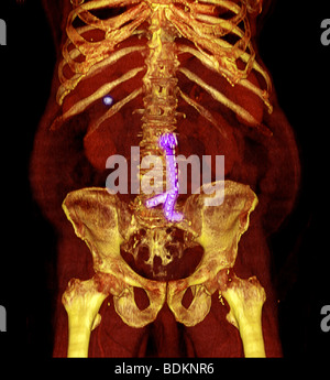 Color enhanced three-dimensional CT scan image of an 80 year old obese ...