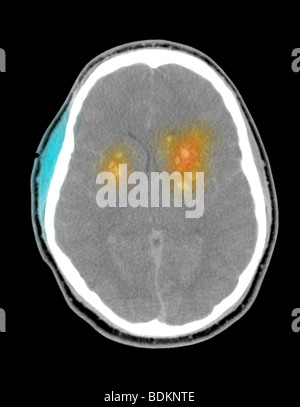 CT scan of a 16-year-old male who was involved in a car accident and ...
