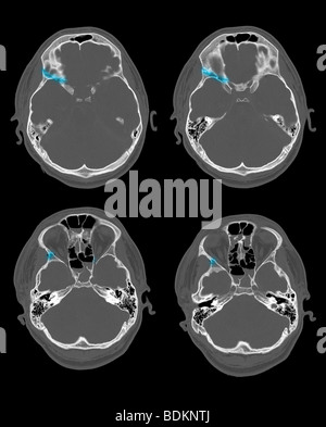 CT scan of a 16-year-old male who was involved in a car accident and ...