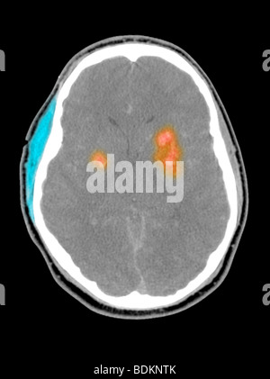 CT scan of a 16-year-old male who was involved in a car accident and ...