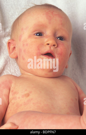 baby with viral rash all over his body Stock Photo - Alamy