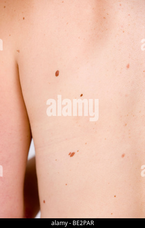 Moles on the back, skin cancer risk Stock Photo - Alamy
