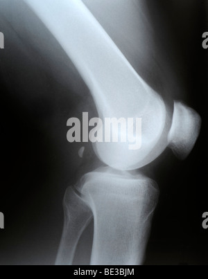 X-ray of the knee, lateral, fabella, sesamoid bone (Os sesamoideum ...