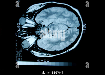 MRI scan of patient's brain with and without contrast agent Stock Photo ...