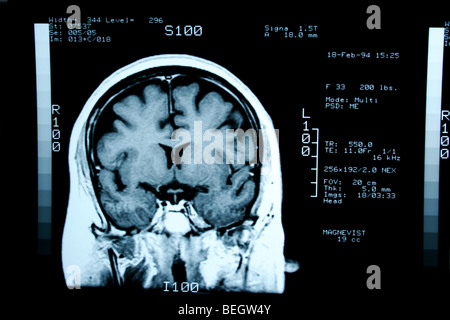 MRI scan of patient's brain with and without contrast agent Stock Photo ...