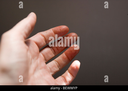 hand injury with blood, blood wound cut top view, copy space, medical ...
