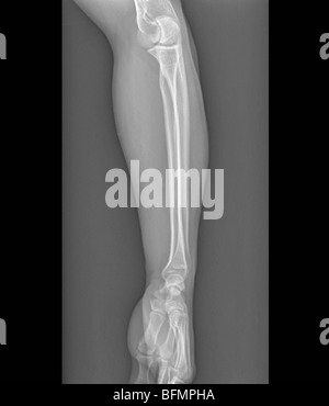 Normal elbow and wrist joints, X-ray Stock Photo - Alamy