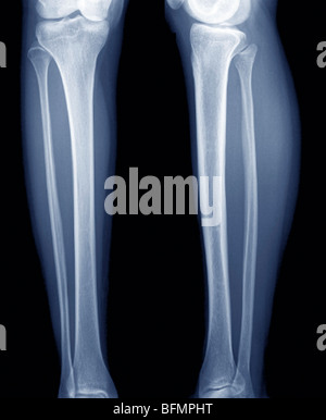 Normal lower legs, X-ray Stock Photo - Alamy