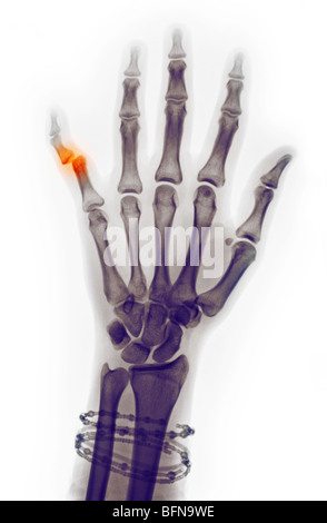 hand x-ray showing a dislocation Stock Photo - Alamy