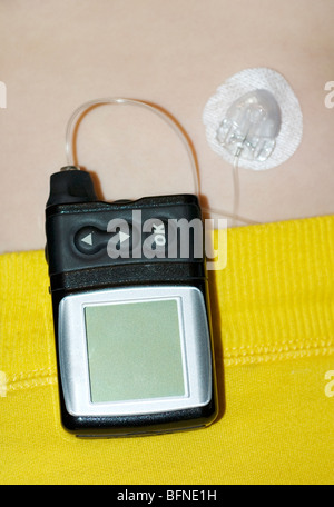 Animas insulin pump Stock Photo - Alamy