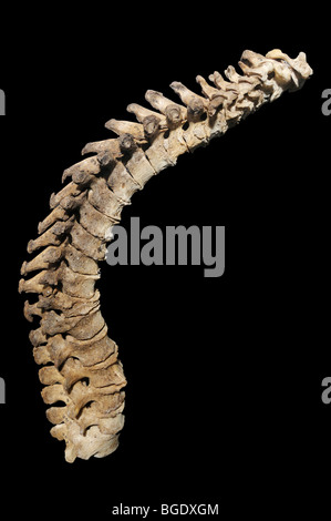 Real Life Hunchback With 100 Degrees Curved Spine Has 100