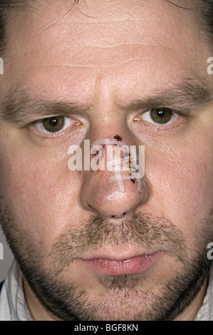 man with steri strips on his nose after a dog bite on the nose Stock ...