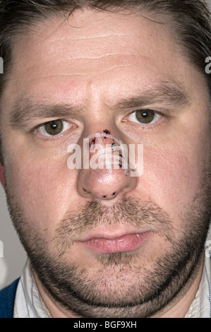 man with steri strips on his nose after a dog bite on the nose Stock ...