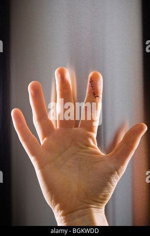 A womans hands with a stitched up cut on the index finger Stock Photo ...