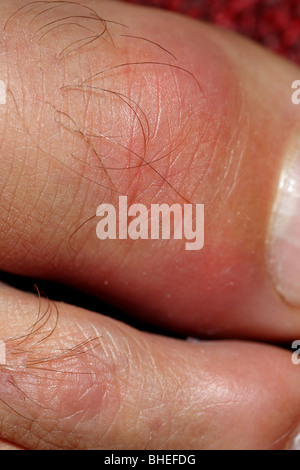 bIG TOE WITH GOUT Stock Photo - Alamy