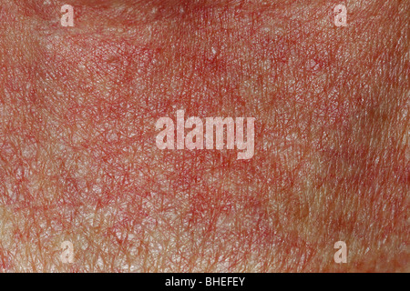 Red skin rash on the neck. Allergic reaction on the skin Stock Photo ...