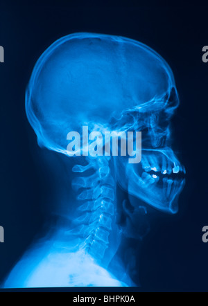 X Ray of human head skull, side view. Cranium medical analysis - Xray ...
