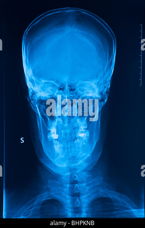 X-ray image of Human Skull Front view for diagnosis skull fracture ...