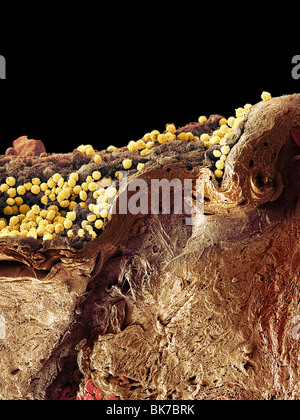 Pyoderma skin disease,SEM Stock Photo - Alamy