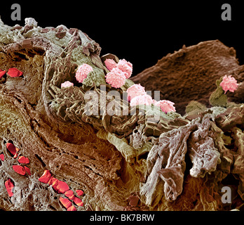Pyoderma skin disease,SEM Stock Photo - Alamy