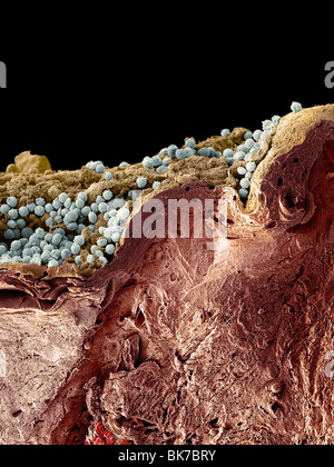 Pyoderma skin disease,SEM Stock Photo - Alamy
