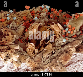 Pyoderma skin disease,SEM Stock Photo - Alamy