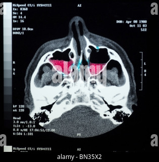 Maxillary sinuses, CT scan Stock Photo - Alamy