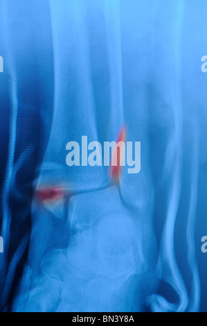 bimalleolar ankle fracture in a fiberglass splint Stock Photo - Alamy