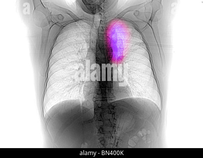 CT scan scout image from a 54 year old man with lung cancer Stock Photo ...