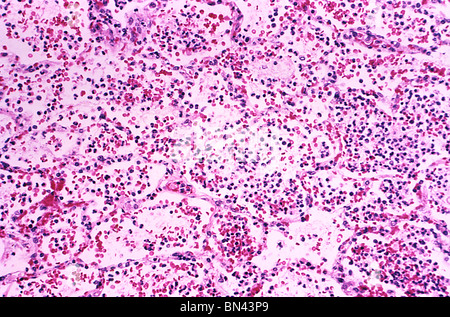 Photomicrograph of histopathologic changes in a case of botryomycosis ...