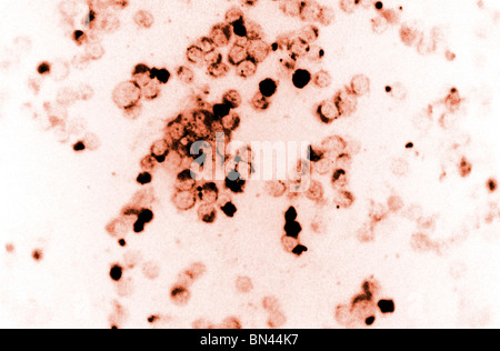 Photomicrograph showing respiratory syncytial virus (RSV) using ...